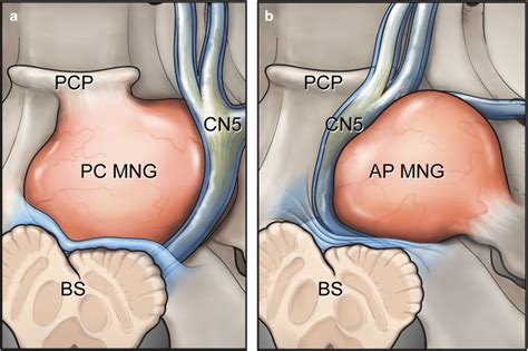 A A Petroclival Meningioma Where The Tumor Origin Site Is The Medial