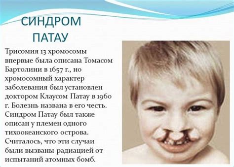 Синдром патау синдром трисомії по хромосомі 13 причини симптоми