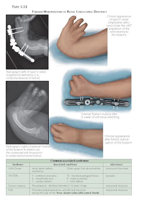 Radial Longitudinal Deficiency Pediagenosis