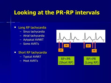 Tachyarrhythmia