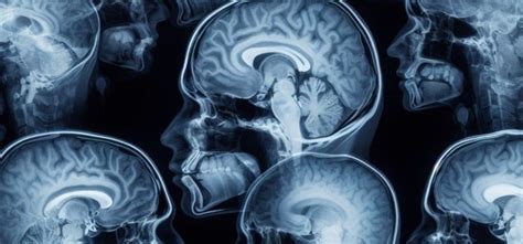 Dr Amen Spect Imaging Beats Symptom Based Diagnosis Shortform Books