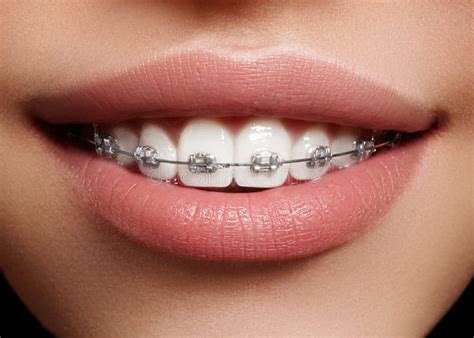 Beautiful White Teeth With Braces Dental Care Photo Woman Smile With