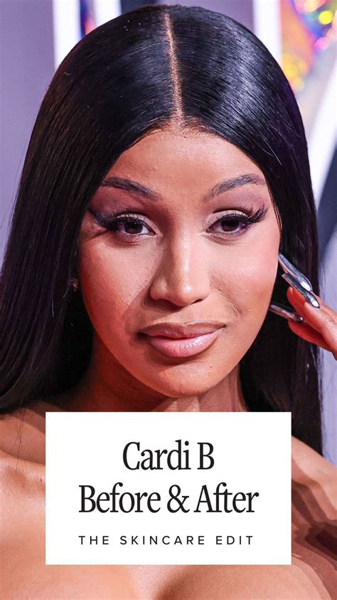 Cardi B Before And After Cardi B Collins Image Botox
