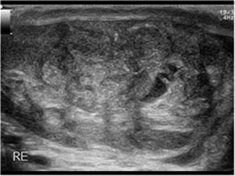 Urinary Tract And Male Reproductive System 23 Scrotum Case 239