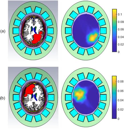Figure 10 From Unsupervised Algorithm For Brain Anomalies Localization In Electromagnetic