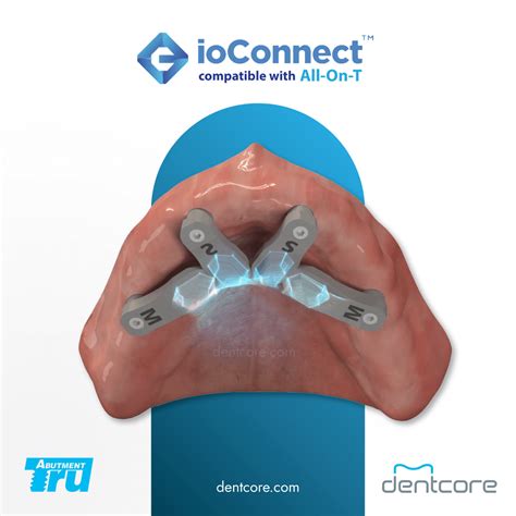 Truabutment Ioconnect All On T Mua Compatible Scanbody Dentcore