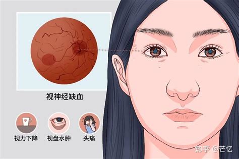 视神经炎有哪些常见的症状表现？ 知乎