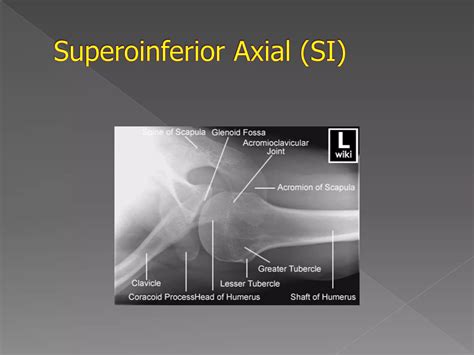 Shoulder X Ray Pptx