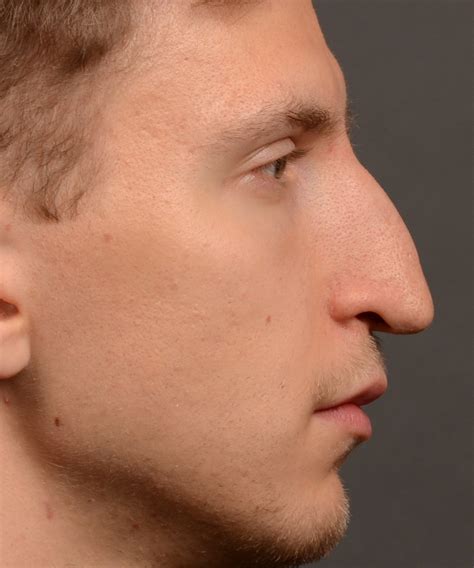 Rhinoplasty Before And After Case 498 Toronto Rhinoplasty Surgery