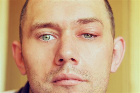 The Best Ways To Treat Styes And The Best Ways To Prevent Them