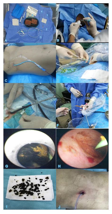 Video A Two Step Method For Percutaneous Transhepatic Choledochoscopic
