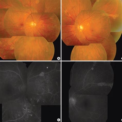 Patient No 21 Fundus Photographs Show Subacute Multifocal Choroiditis Download Scientific