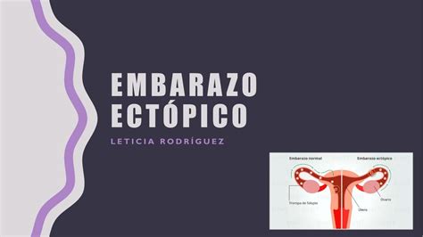 Embarazo Ectópico Amarilis Lopez Udocz