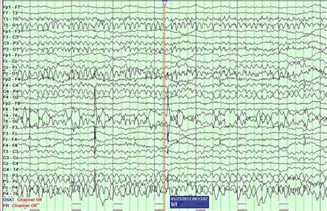 Eeg Hospital Day 5 Rhythmic Sharp Theta Discharges Starting In The