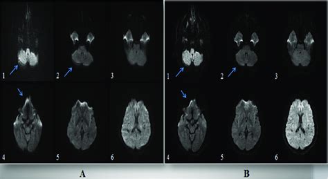 Use Of Parallel Imaging Technique For Geometric Distortion Artifacts Download Scientific
