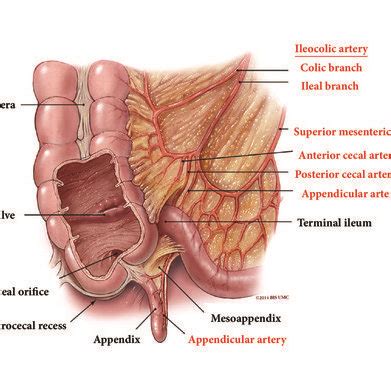 Endoscopic Image Of Lipomatous Hyperplasia Of The Ileocecal Valve Due