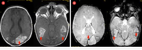 Figure 1 From Pallister Killian Mosaic Syndrome In An Omani Newborn A