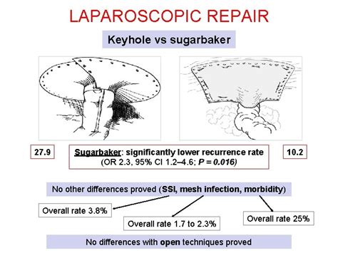 How To Repair Parastomal Hernias Overview Y RENARD