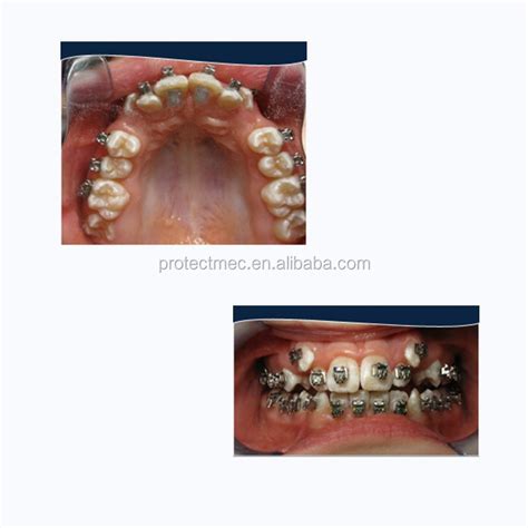 Bite Turbos Are Small Dental Braces Accessories Buy Bracesbraces