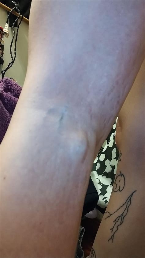 Axillary And Inguinal Lymph Node Swelling 7 Years With Pics R Diagnoseme