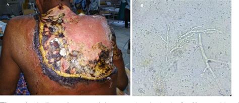 Figure 1 From A Rare Case Of Apophysomyces Variabilis Skin And Soft Tissue Infection Semantic