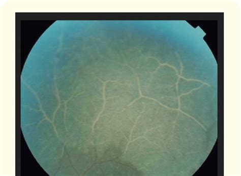 White Vessels Within Area Of Retinal Whitening In Malarial Retinopathy