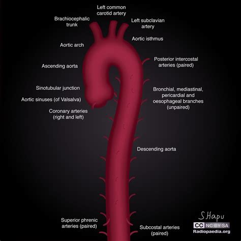 Thoracic Aorta Diagrams Radiology Case Thoracic