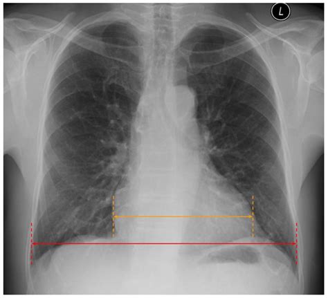 Chest X Ray Of Heart Failure At Pearl Brandon Blog
