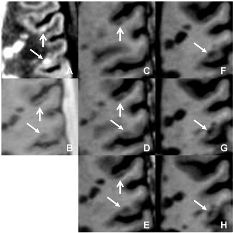 3d Mprage Improves Classification Of Cortical Lesions In Multiple