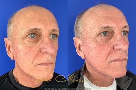 BOTOX Cosmetic Before And After Pictures Case 223 Guilford CT