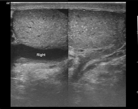 Testicular Microlithiasis Pacs