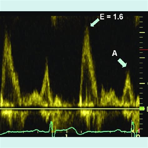 Determination Of Mitral Inflow By An Instantaneous Velocityvalve Area