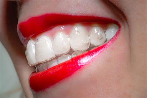 5 Amazing Benefits Of Invisalign In 2019 Weiss And Tor Orthodontics