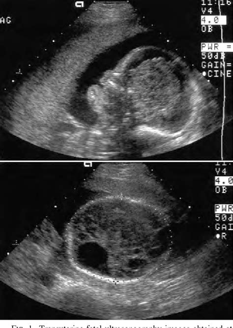Figure 1 From Giant Intracranial Teratoma And Lack Of Cortical Development In A Fetus Case