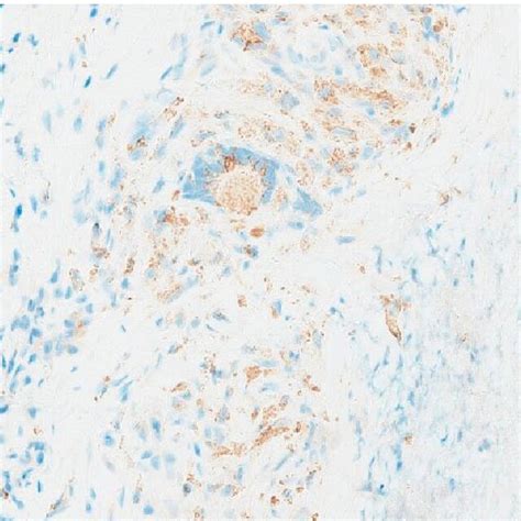 Histopathological Image Hematoxylin And Eosin Staining Of The Biopsy