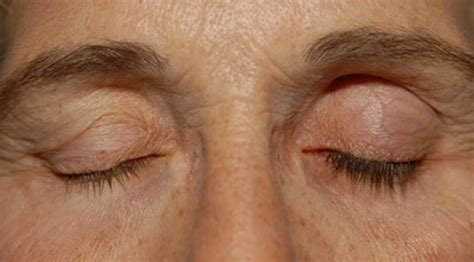 Medical Management Of Glaucoma A Primer