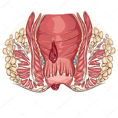 Vector Illustration Of A Hemorrhoids Stock Vector Image By