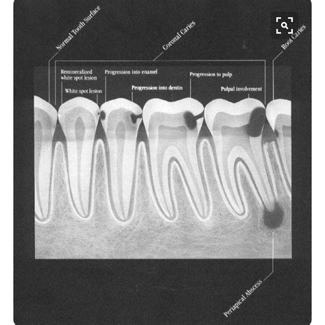 Tooth Abscess Xray