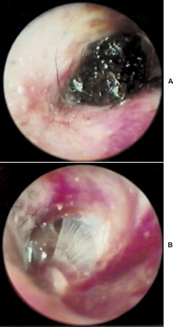 Ceruminous Diseases Of The Ear Veterian Key