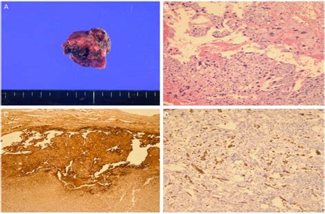 A Gross Appearance Of The Ovarian Tumor The Cut Surface Shows