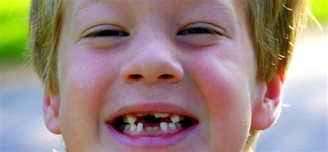 O Que Significa Sonhar Dente Quebrado