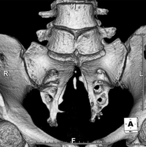 Three Dimensional Reconstruction Of Pelvic Computed Tomographic