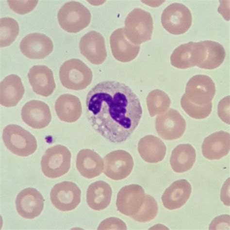 Vacuolization Appearance And Clinical Significance Medlabbuddy