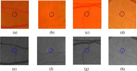 Automated Microaneurysm Detection In Diabetic Retinopathy Using