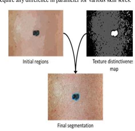 Figure 4 From Skin Cancer Detection Using Image Processing Technique Semantic Scholar