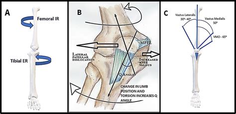 Lateral Patellar Dislocation A Critical Review And Update O JBJS Reviews