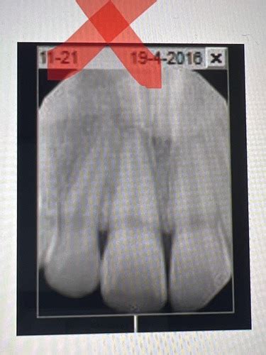 Dr 113 Exposure And Technique Errors Flashcards Quizlet
