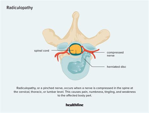 Lumbar Radiculopathy Symptoms Causes Diagnosis Treatment