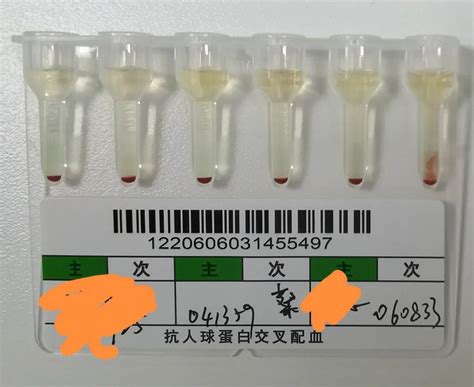 次侧交叉配血不合2例分析处理 知乎