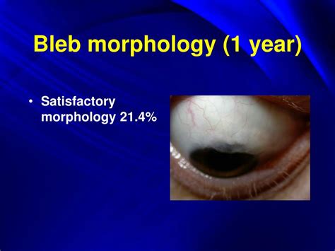 Ppt Trabeculectomy Mmc Audit Powerpoint Presentation Free Download